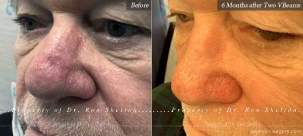 Vbeam Laser NYC | Before and After Vbeam - Ron Shelton MD