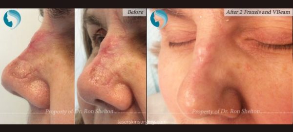 Vbeam Laser NYC | Before and After Vbeam - Ron Shelton MD