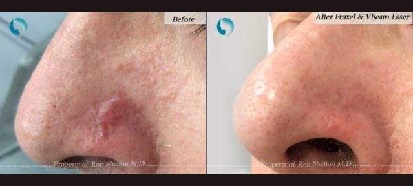 Vbeam Laser NYC | Before and After Vbeam - Ron Shelton MD