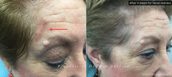 Vbeam Laser NYC | Before and After Vbeam - Ron Shelton MD