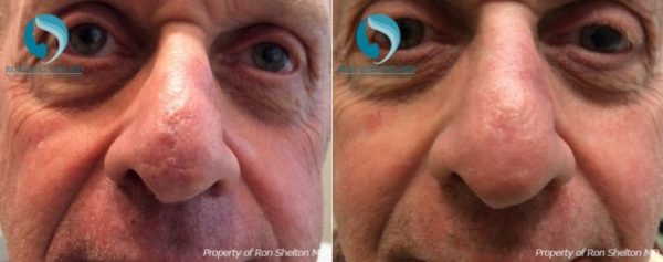 Fraxel New York City: Skin Resurfacing Solution , Ron Shelton MD