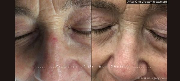 Vbeam Laser NYC | Before and After Vbeam - Ron Shelton MD