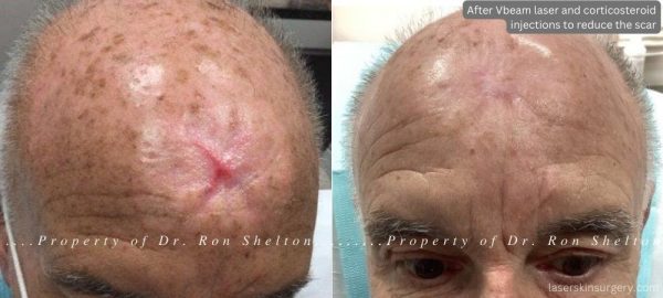 Vbeam Laser NYC | Before and After Vbeam - Ron Shelton MD