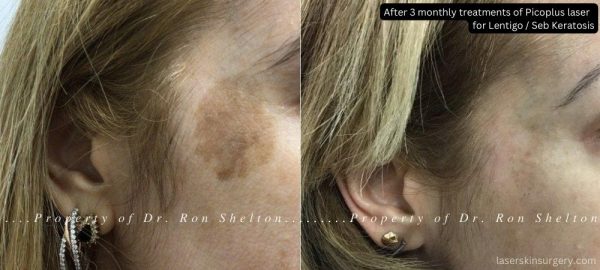 Brown Spots Dark Spots Laser Removal Before After NYC