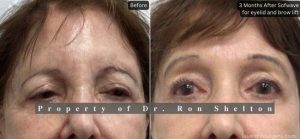 Sofwave skin tightening Before After NYC | Sofwave Ultherapy NY