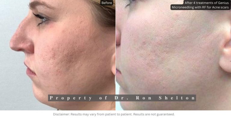 Microneedling with RF Before and After photos | Ron Shelton MD