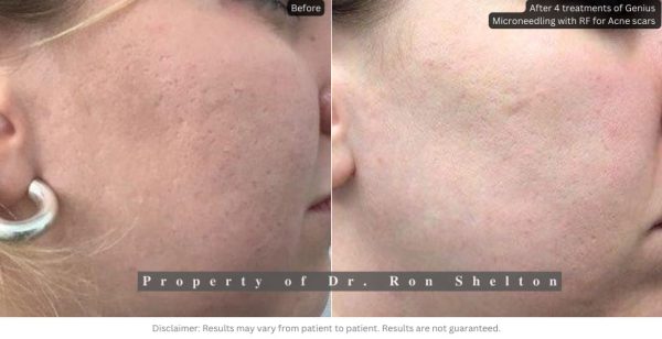 Microneedling with RF Before and After photos | Ron Shelton MD