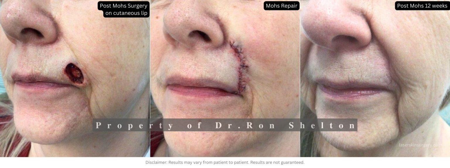 Mohs reconstruction New York | Before After photos Mohs surgery