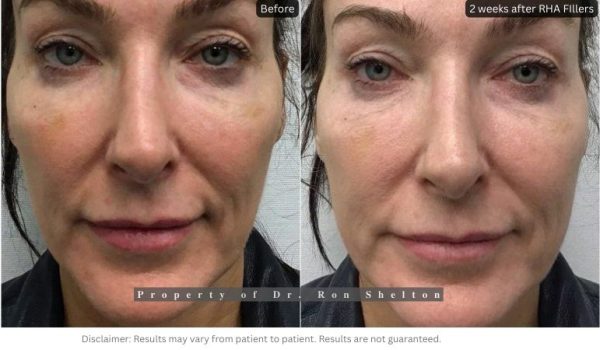 Resilient Hyaluronic Acid RHA® Before After Photos - Ron Shelton M.D.