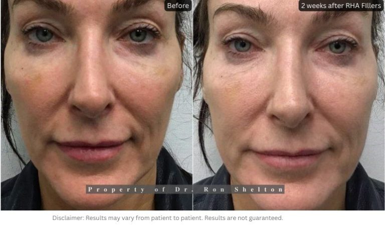 Resilient Hyaluronic Acid RHA® Before After Photos - Ron Shelton M.D.