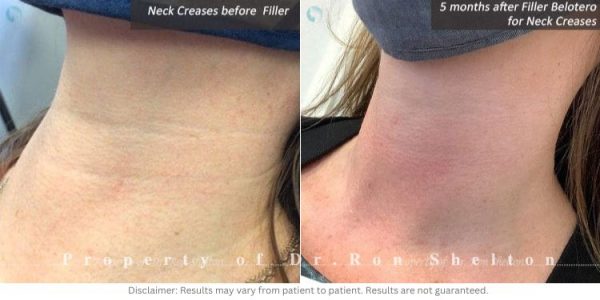 Dermal Fillers NYC: FDA Approved Dermal Filler Treatments