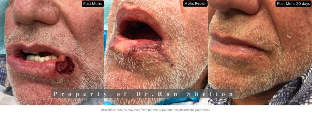 Mohs reconstruction New York | Before After photos Mohs surgery