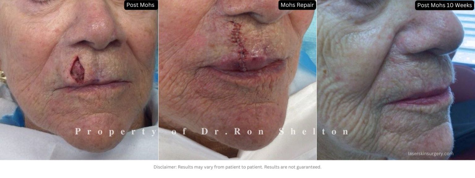 Mohs reconstruction New York | Before After photos Mohs surgery
