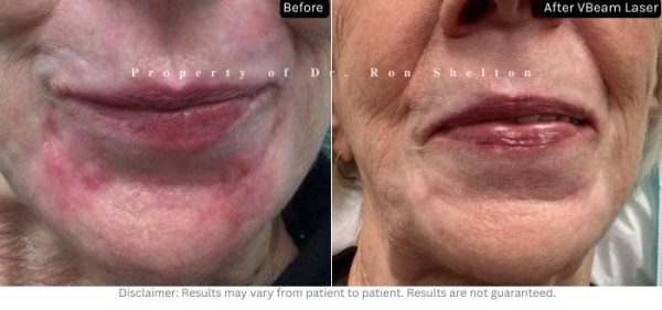 Vbeam Laser NYC | Before and After Vbeam - Ron Shelton MD