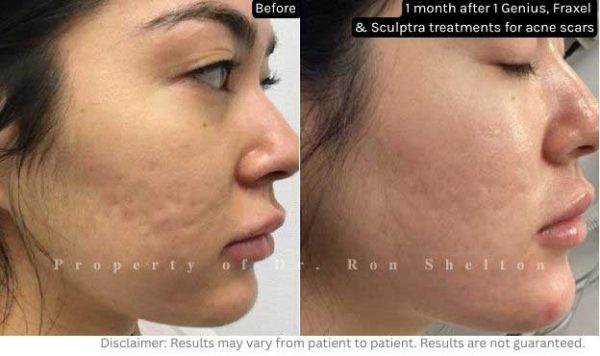 Microneedling with RF Before and After photos | Ron Shelton MD