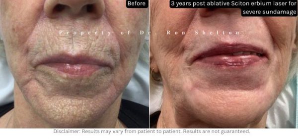Laser skin resurfacing before and after photo gallery New York City