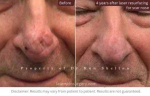 Laser skin resurfacing before and after photo gallery New York City