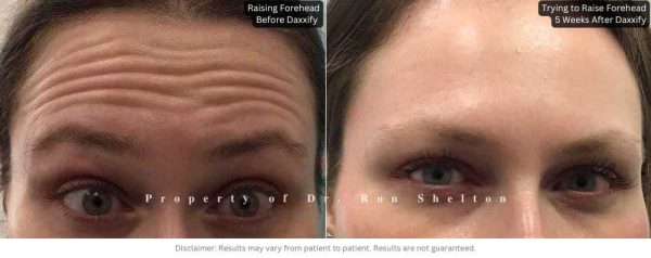 NYC Daxxify Before and After | Ron Shelton M.D. patient photos